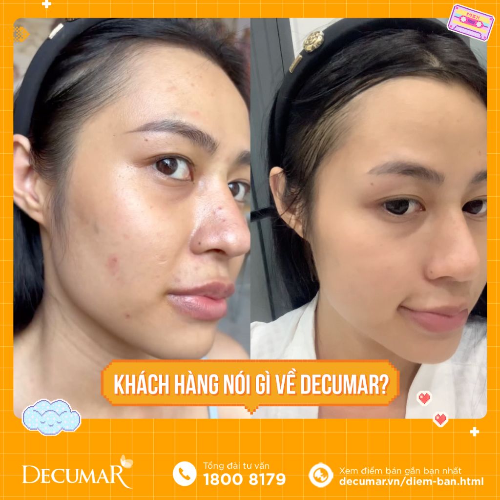Gel ngừa mụn Decumar Advanced 20g, thẩm thấu nhanh không kích ứng, hiệu ...